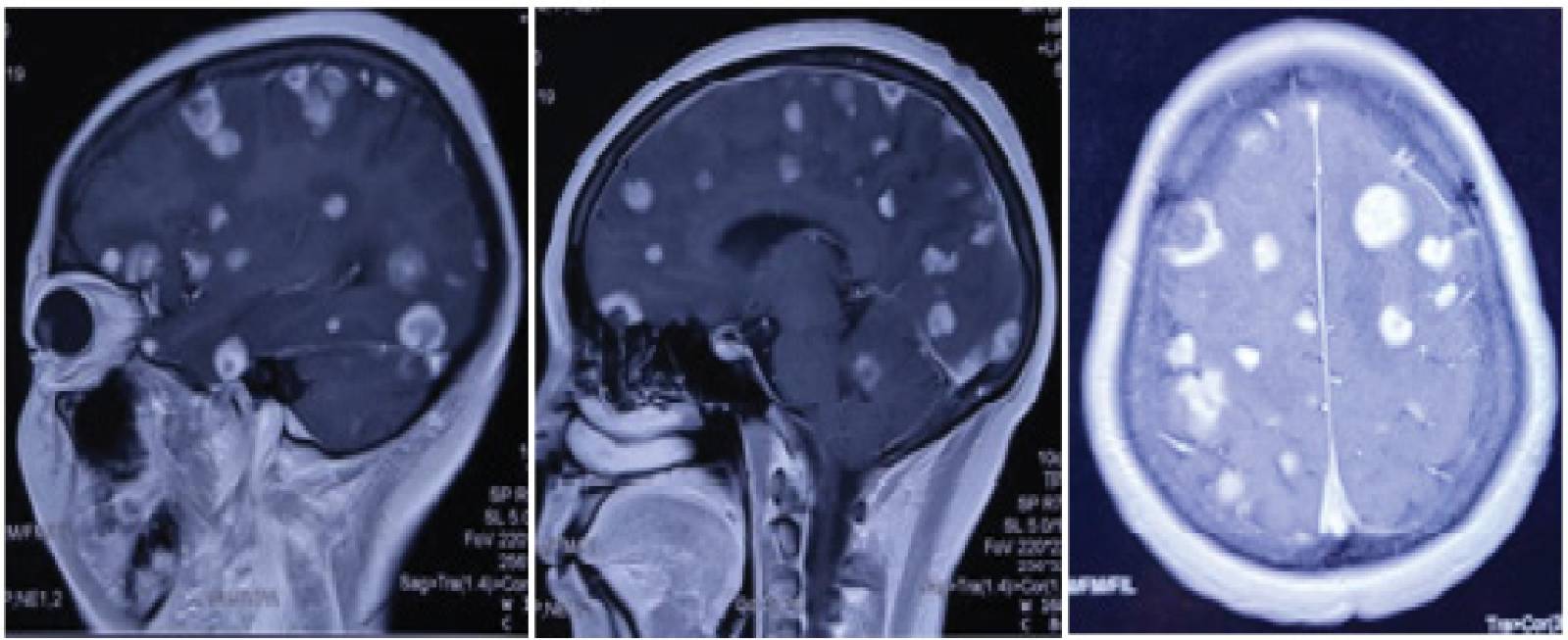 AntiCancer Effects of Hydrogen Gas Inhalation - Jeffrey Dach MD